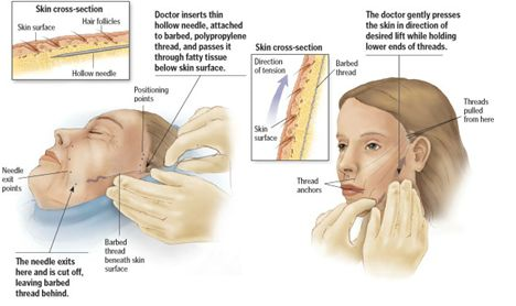 Thread Face Lift – Dermacare Skin & Laser Centre